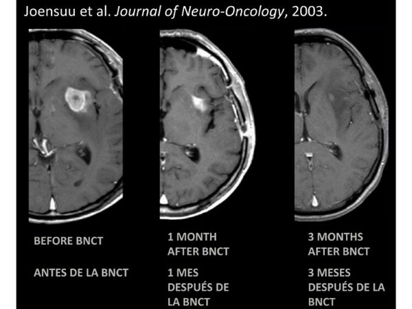 Todo lo que necesitas saber sobre BNCT - Neutrones para medicina